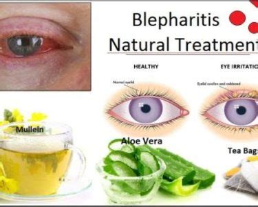 Easy Home Remedies For Eye Infection Blepharitis Herbal Care Products