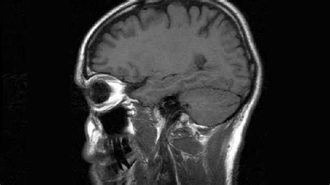 Mri Brain Scans Detect People With Early Parkinsons Technology Networks