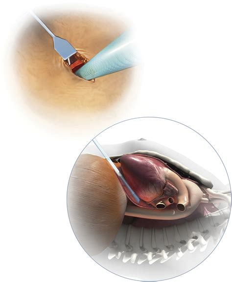 Subxiphoid Endoscopic Epicardial Ventricular Tachycardia Ablation The