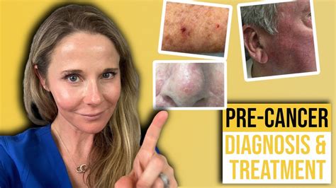 Actinic Keratosis Pictures Before After