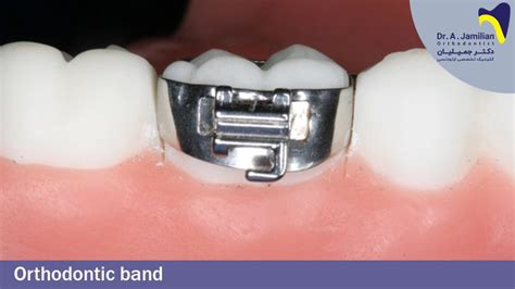 Orthodontic Rubber Band Positions At Kathleen Lynch Blog