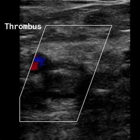 Thrombolysis And Stenting For Dvt In A Patient With May Thurner