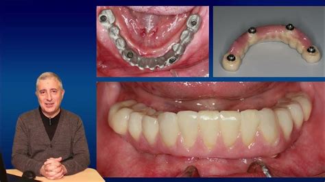 Что лучше винтовая или цементная фиксация коронок на импланты Часть 2 Мосты на имплантатах