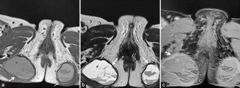 Ischial Bursitis Meded Cases