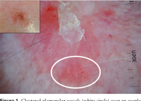 Figure 1 From Dermoscopy As A Tool In Differentiating Cutaneous Squamous Cell Carcinoma From Its
