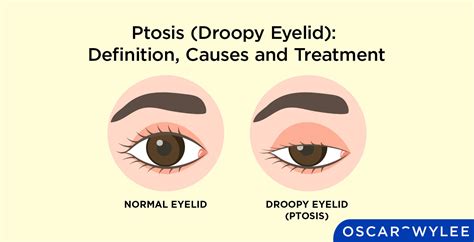 Ptosis Droopy Eyelid Definition Causes And Treatment