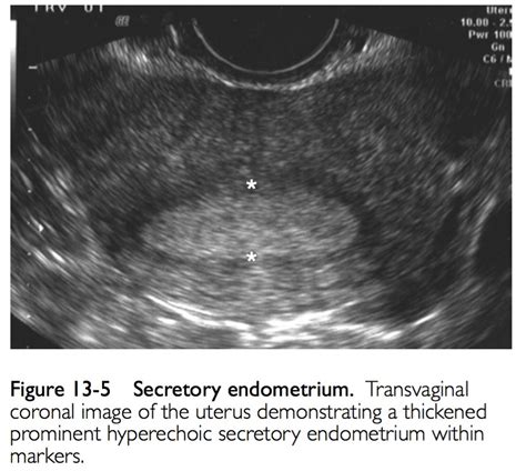 What Is A Window In The Uterus At Grace Fuhrman Blog