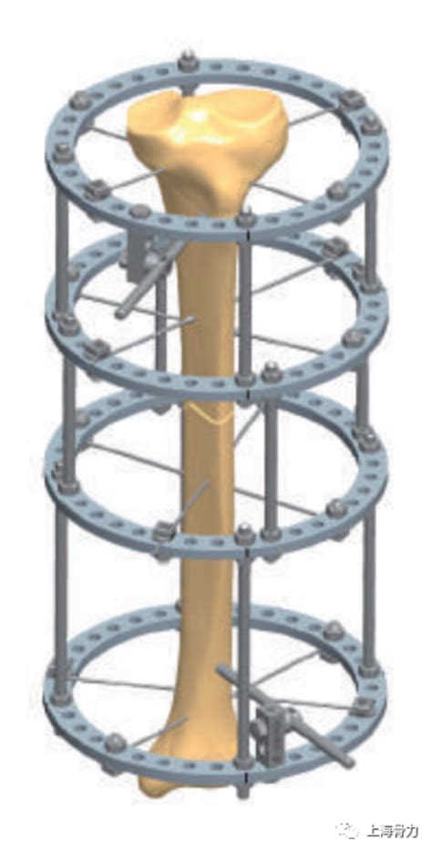 News External Fixation Bracket External Fixation Technique Of Distal Tibia