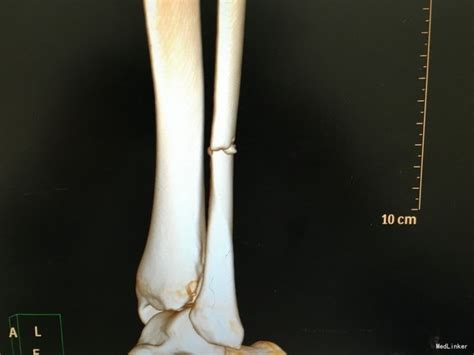 左胫腓骨远端粉碎性骨折并踝关节半脱位 医联