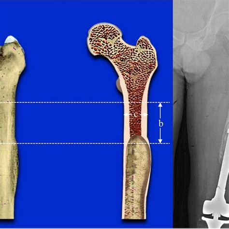 The Femoral Cortical Bone Bulges And The Prosthesis Penetrate The