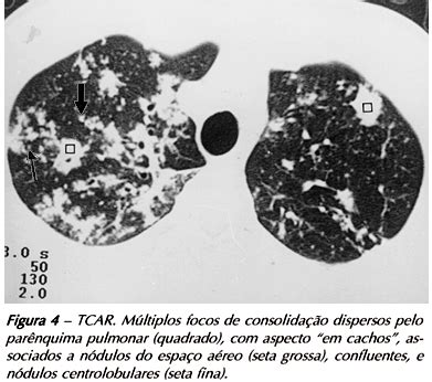Scielo Brasil Tuberculose Pulmonar Achados Na Tomografia