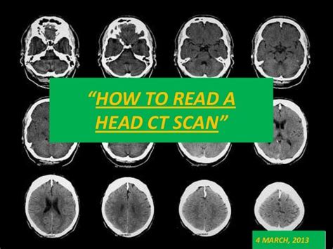 How To Read A Head Ct Scan Faculty Of Medicine