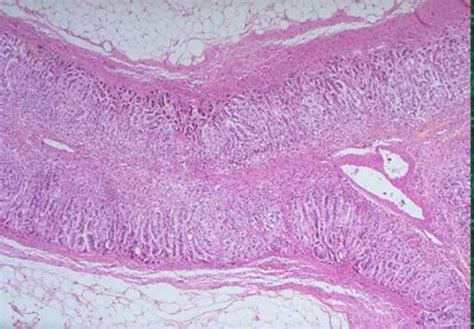 Endocrine Pathology Flashcards Quizlet