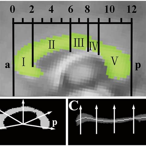 Diffusion Tensor Imaging Dti Tractograpy The Color Coding Of