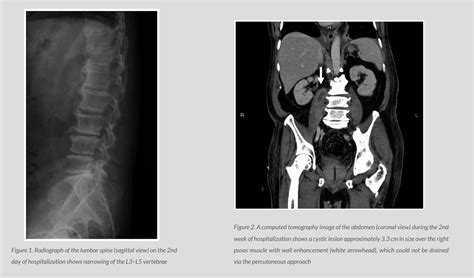 Figure 2 From Spondylodiscitis With Epidural And Psoas Muscle Abscesses As Complications After