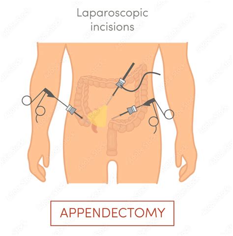 Laparoscopic Appendicectomy Bariatric Surgery Malaysia