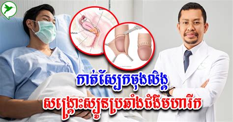 វេជ្ជ ប្រាប់បុរសកាត់ស្បែកចុងលិង្គអាចសង្រ្គោះដៃគូមិនឲ្យកើតជំងឺមហារីកមាត់ស្បូន