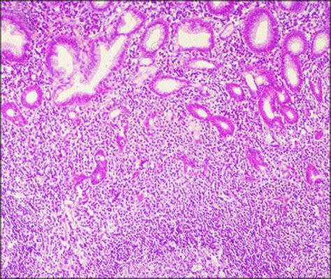 Gastric Malt Lymphoma From Aetiology To Treatment The Lancet Oncology