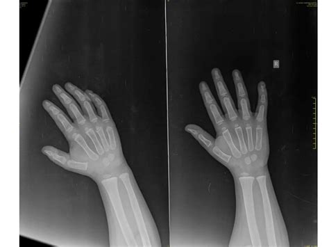 Age Estimation By Radiological Method Using X Rays Pptx