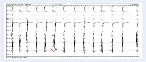 An Intracardiac Electrograms During Jet The Image Shows Junctional Download Scientific Diagram