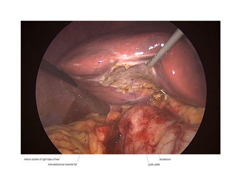 Mini Laparoscopic Cholecystectomy W Ioc Brunt 2017 Surgical Education Learn Surgery
