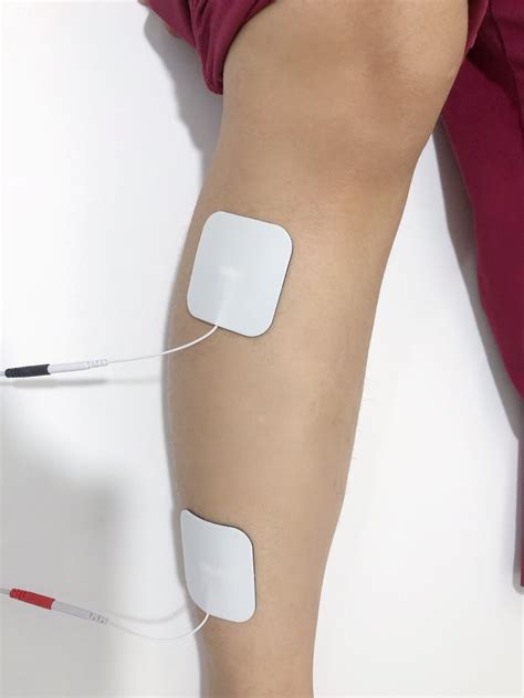 Electrical Stimulation การรักษาโดยการกระตุ้นไฟฟ้า Motioncareclinic