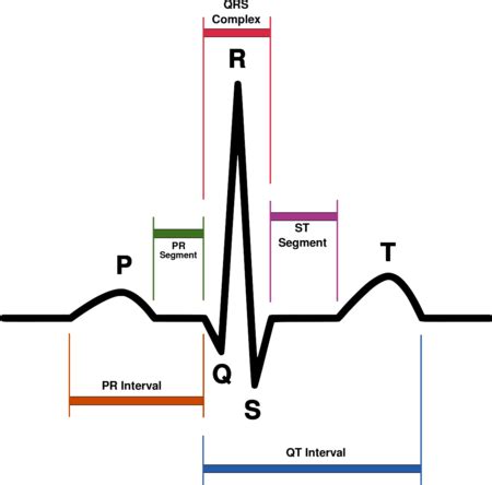 Pathologic Q Waves WikEM