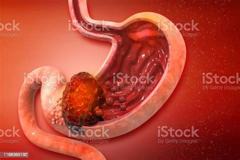 위암 암 공격 세포 위 질환 개념 3d 일러스트레이션 건강관리와 의술에 대한 스톡 사진 및 기타 이미지 건강관리와 의술 경련 궤양 Istock