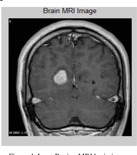 Figure 4 From Brain Tumor Detection And Segmentation Based On Component