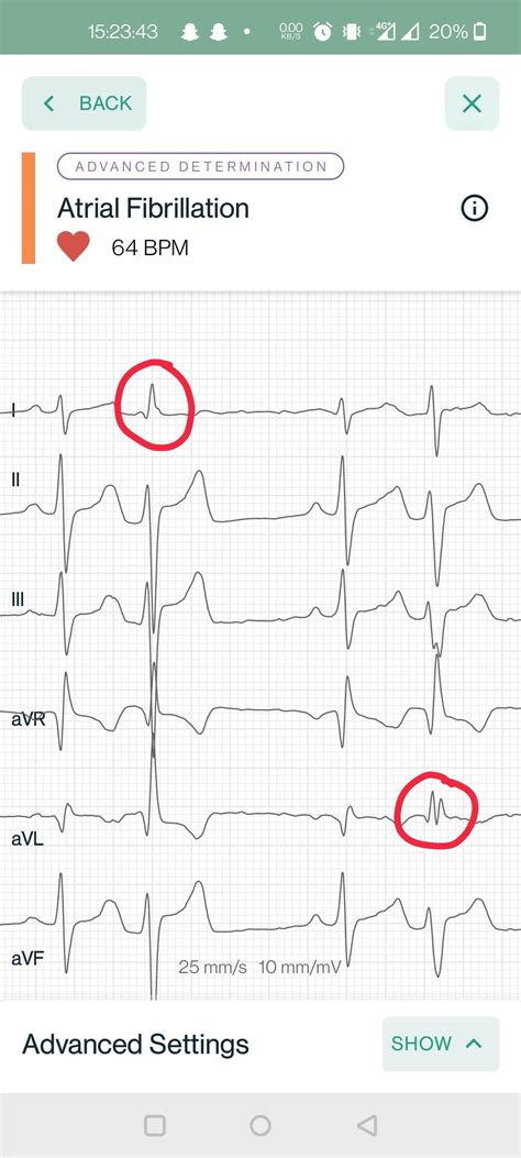 Ignore The Afib Detection I Know Its Definitely Not Afib R Checkmyecg