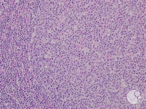 Hyperplastic Follicle With Polymorphous Cells