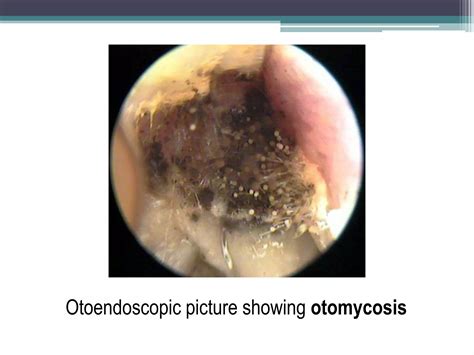 Otoendoscopy Types Uses Procedures Performed Advantages And Disadvantages Pptx Ear