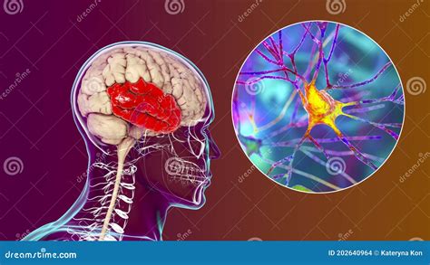 Human Brain With Highlighted Temporal Lobe And Close Up View Of Neurons Stock Illustration