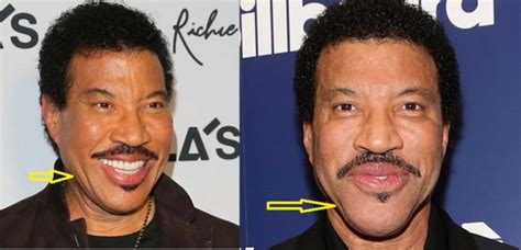 Lionel Richie Plastic Surgery Luciaconner