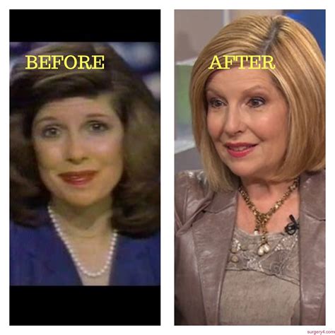 Sandie Rinaldo Plastic Surgery Photos [before And After] Surgery4