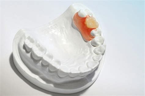 Provisorische Sunflex Brücke Auf Mit Modell Zahn Docs Diez