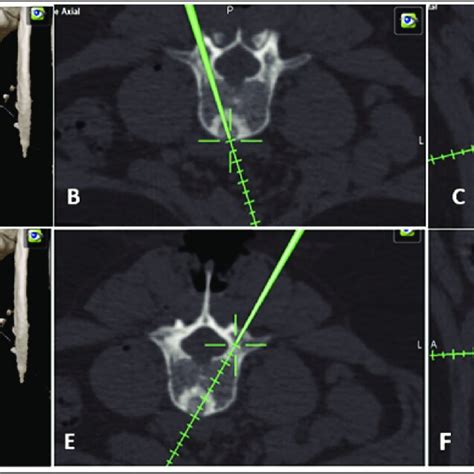 Intraoperative Ct Navigated Images Showing 3d Tumor Localization Via
