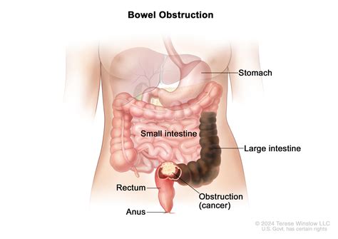 Bowel Obstruction And Cancer Treatment Chemoprescribe Llc