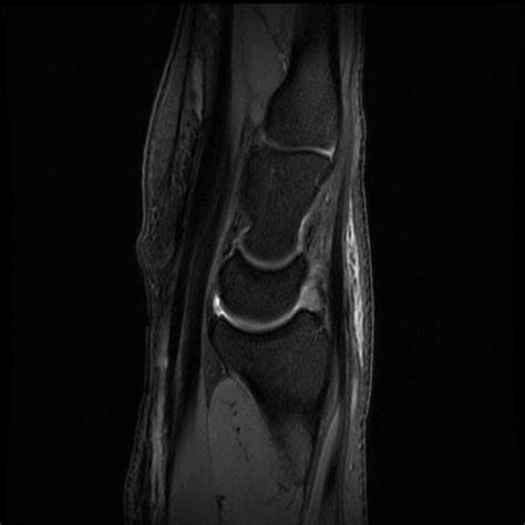 Wrist Mr Arthrogram