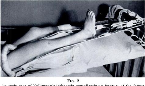 Ischemic Contracture Semantic Scholar