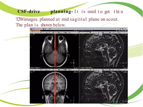 CSF Flow Study In MRI PPTX