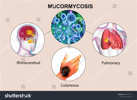Rhinocerebral Mucormycosis