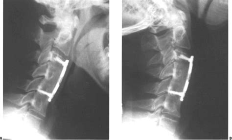 Adjacent Level Degeneration Neupsy Key