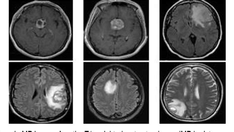 Figure 1 From Mri Brain Tumor Classification Using A Hybrid Vgg16 Nade Model Semantic Scholar