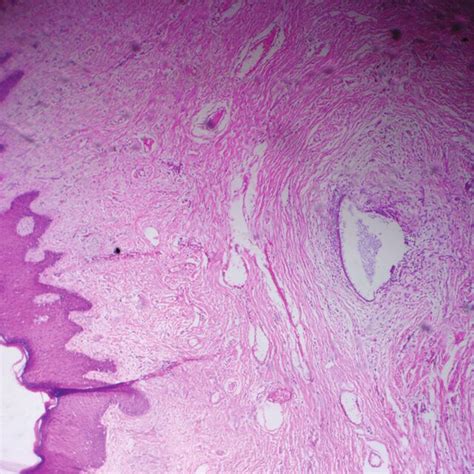 Histological Subtypes Of Prostate Cancers And Patients Age