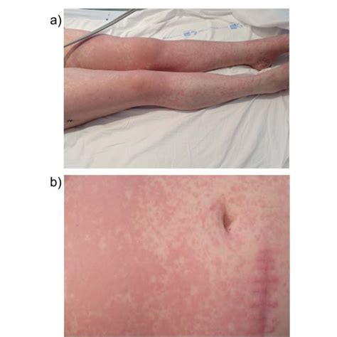 A B Maculopapular Rash In Limbs And Abdomen Download Scientific Diagram