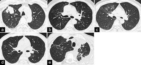 Radiological Manifestations Of Igg4 Related Lung Disease On Chest Download Scientific Diagram