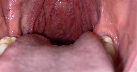 Bumps On Back Of Tongue And Throat