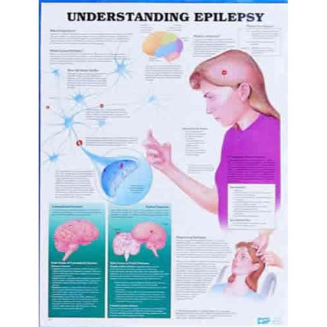 Understand Epilepsy Chart