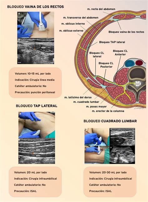 Bloqueos De Nervio Y Cirugía Ambulatoria Aproximación Infográfica